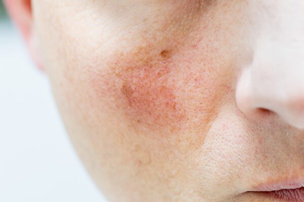 Those Tiny Red Lines: Understanding Broken Capillaries - SISÄ Skincare