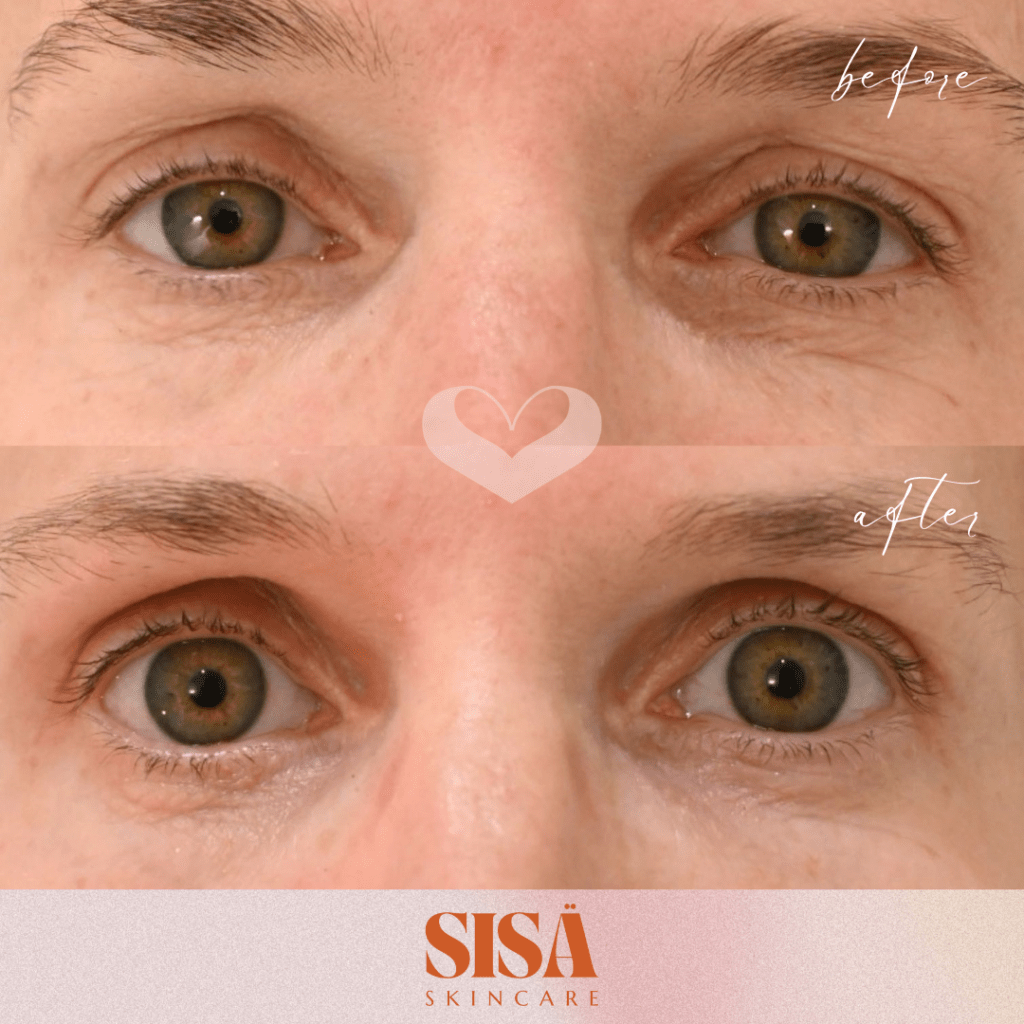 Rejuran Skin Treatment in Sydney | Sisä Skincare